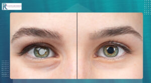 Cataract Surgery: What to Expect Before, During, and After the ...